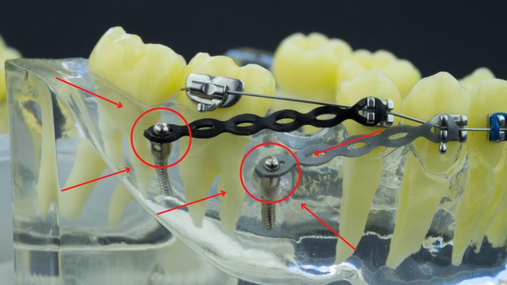 Implante dentário - Blog OralDents