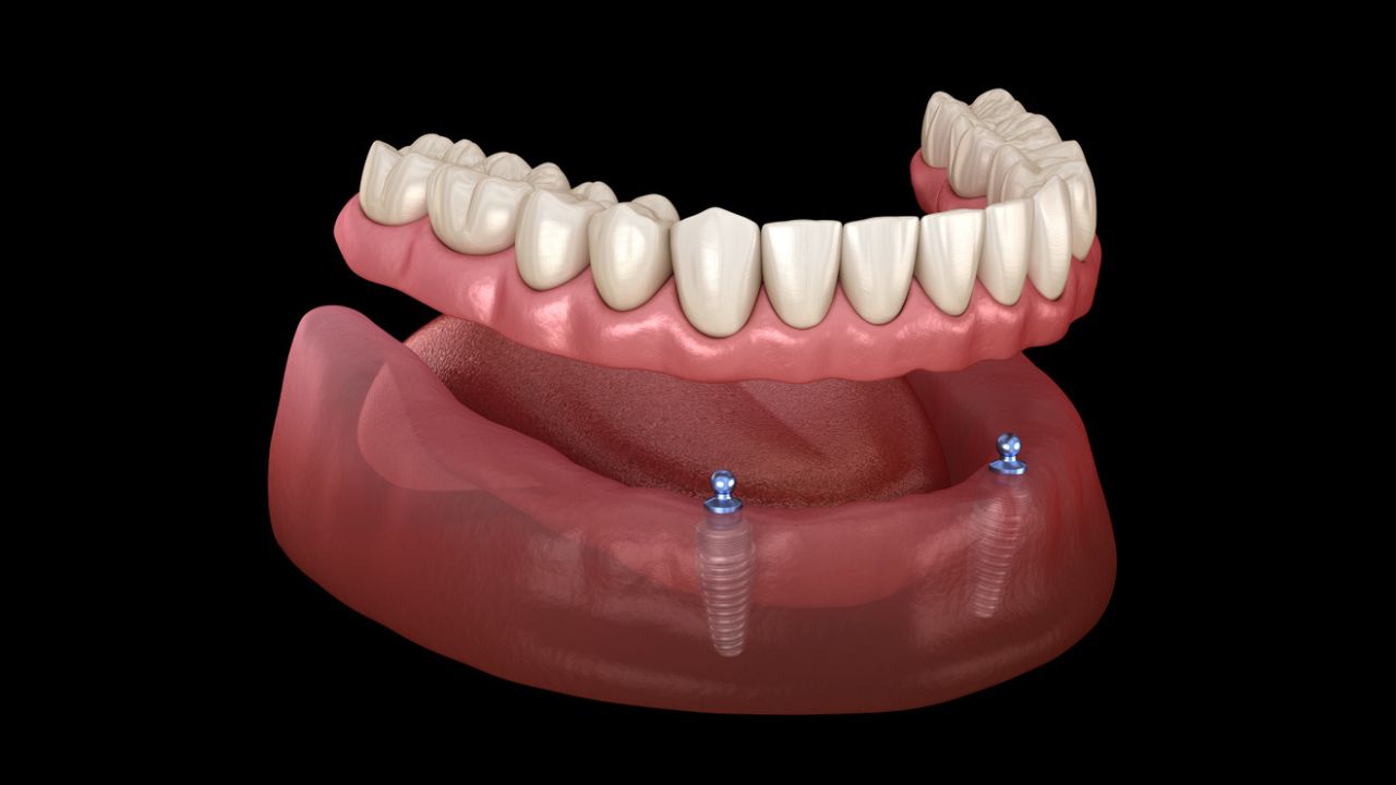 Prótese overdenture: indicações, vantagens e cuidados!