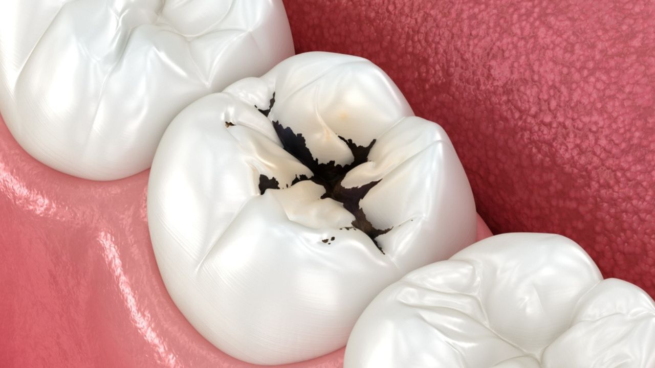 Dente com cárie: confira como surge e como tratá-lo!
