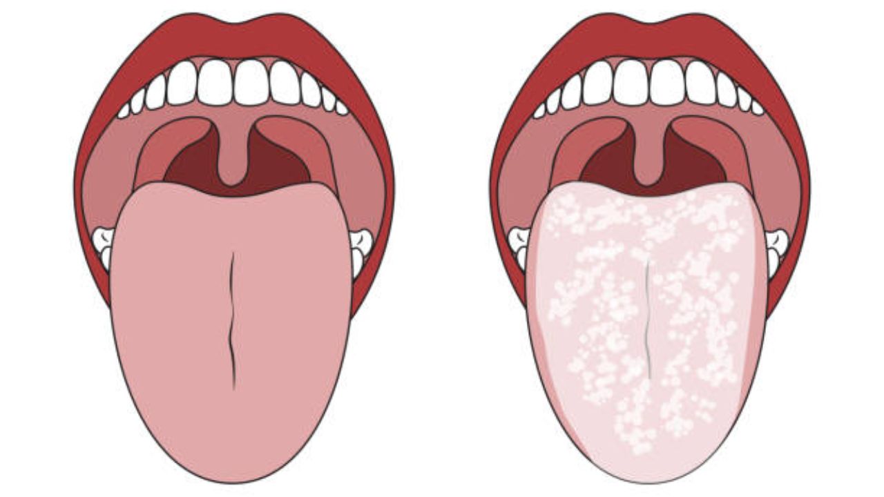 Sapinho na lingua: o que é, causas, prevenção e como tratar!