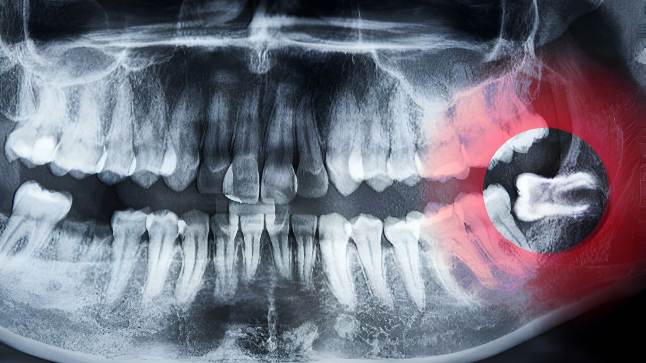 Siso nascendo? Veja aqui, dúvidas e dicas sobre o dente!