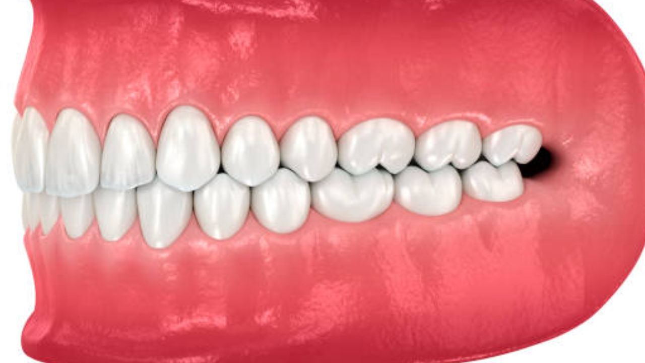Qual a função do dente molar? Saiba tudo sobre o dente aqui!